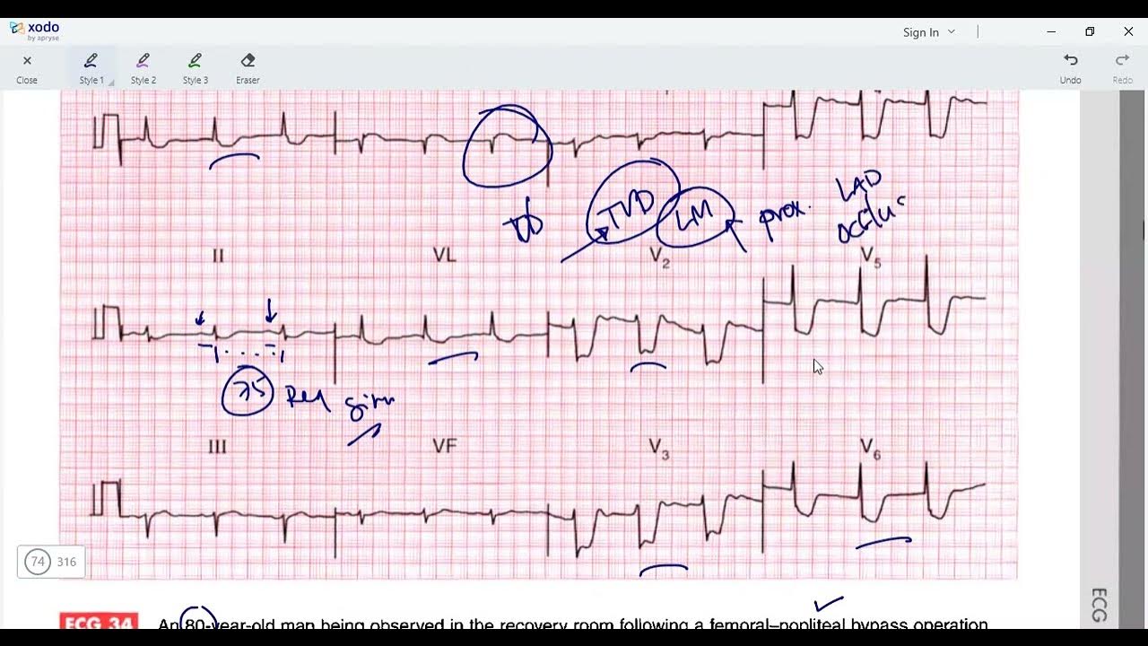 Lets practice ECG, Session 2 - YouTube