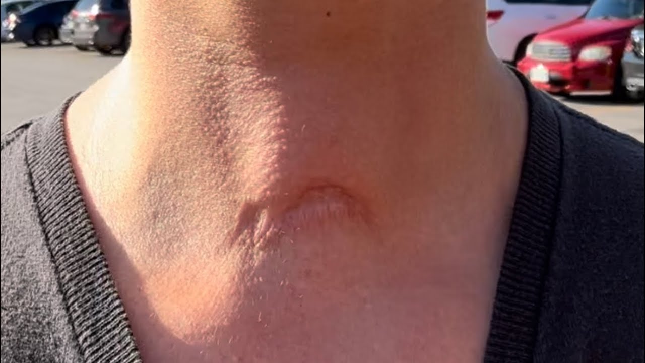 Alix Neck Scar Story - YouTube