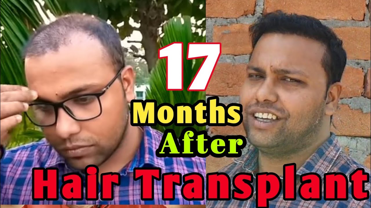Hair Transplant Result After 18 Months Best Hair Transplant In