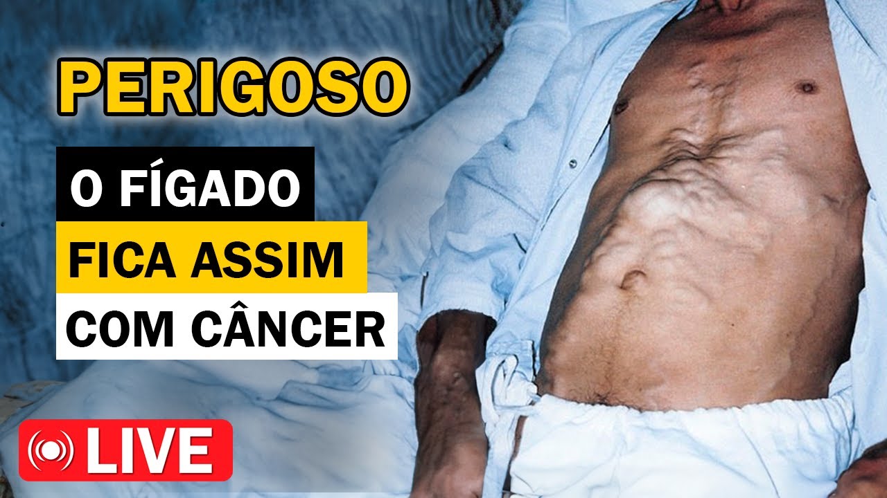🔴 [LIVE] CÂNCER de FÍGADO: OLHA COMO FICA A BARRIGA - SINTOMAS - YouTube