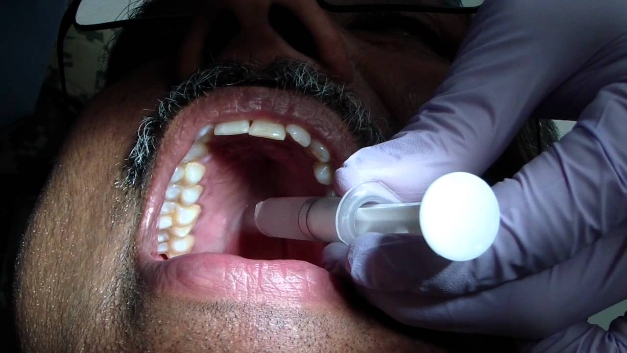 Greater Palatine Anesthesia with Ice - Take 5 - YouTube