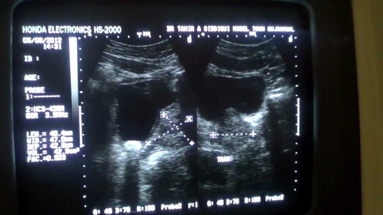 ultrasound : CALCULUS within U - BLADDER LUMEN - YouTube