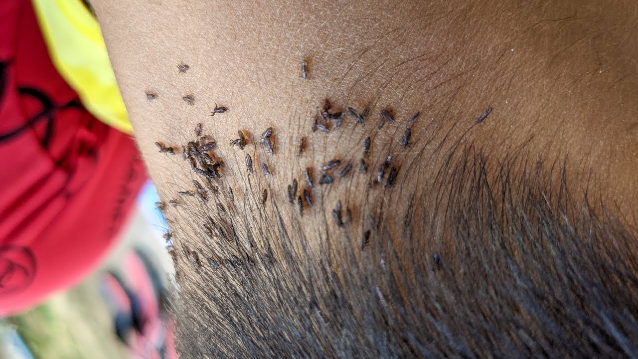Take out all hundred lice from black hair - Getting out all big lice ...