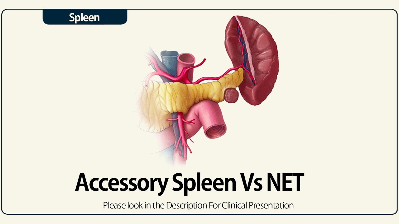 Accessory Spleen Vs NET - YouTube