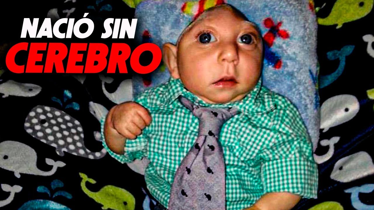 El NIÑO que NACIÓ sin CEREBRO - YouTube