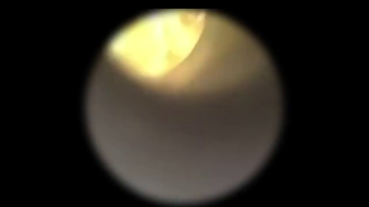 EAR WAX REMOVAL USING ST BARTS HOOK & JOBSON HORNE - YouTube