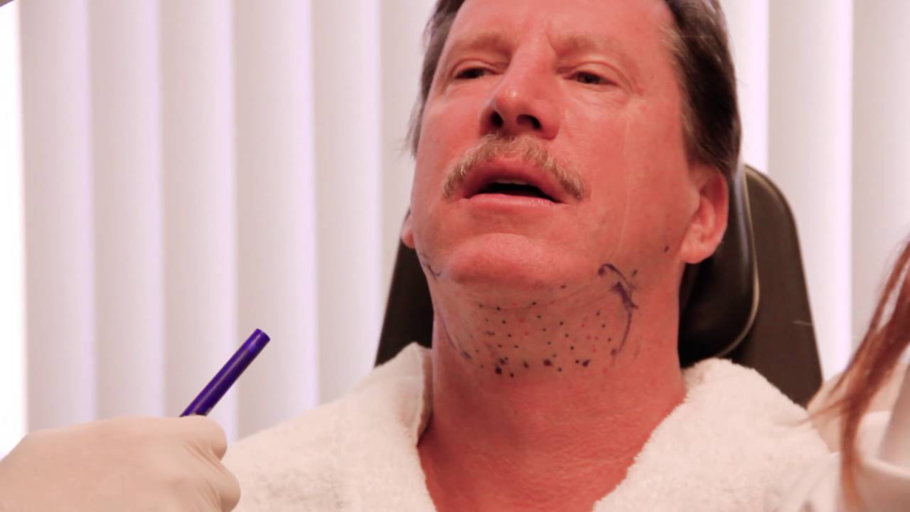 Male patient interested in Kybella for his neck - YouTube