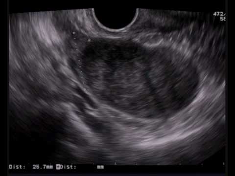 Sospetto fibroma ovarico - YouTube