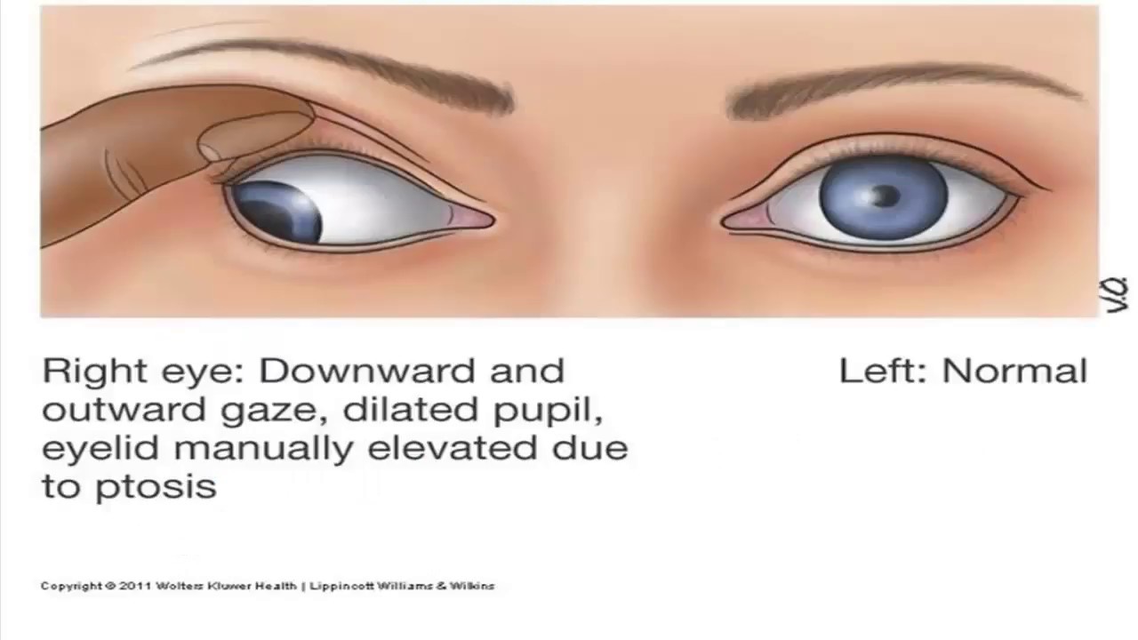 How to remember Cranial Nerves, part 4: Abducens (CN-VI) and Oculomotor ...