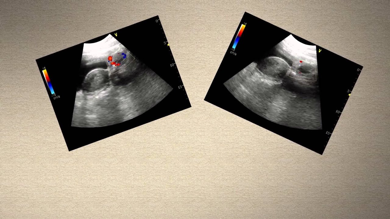 Ectopic pregnancy scan - YouTube