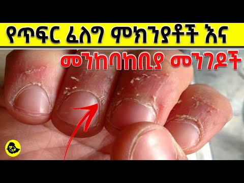 የጣት ላይ ፈለግ የሚከሰትበት ምክንያቶቹ፣ ምልክቶች እንዲሁም መፍትሄዎቹ | skin peeling around finger nails | Ethealth