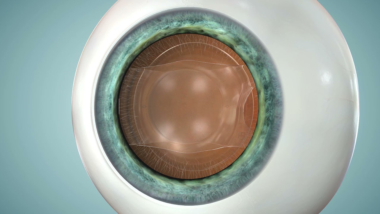 Visian Toric ICL Procedure Overview - Dr. Sandy T. Feldman - YouTube