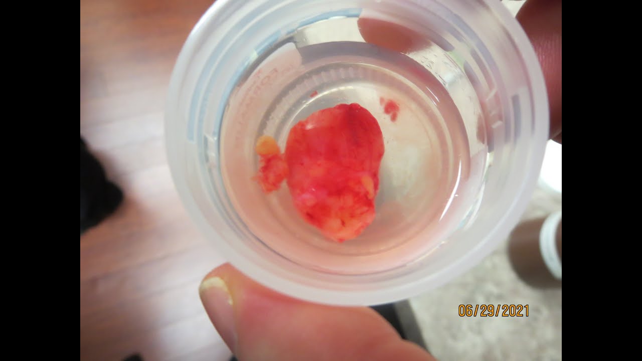 Long Form Lipoma Excision 🔪 by Dr. H.L. Greenberg at Las Vegas ...