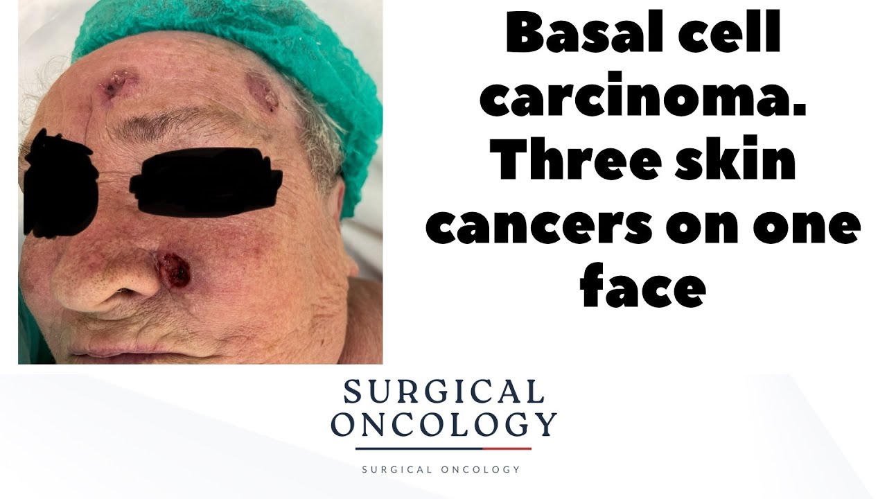 Basal cell carcinoma. Three skin cancers on one face. Surgical ...