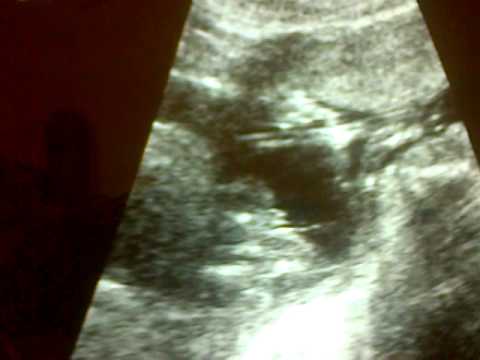 18 week scan?? BOY or GIRL bits??? Confused.com - YouTube