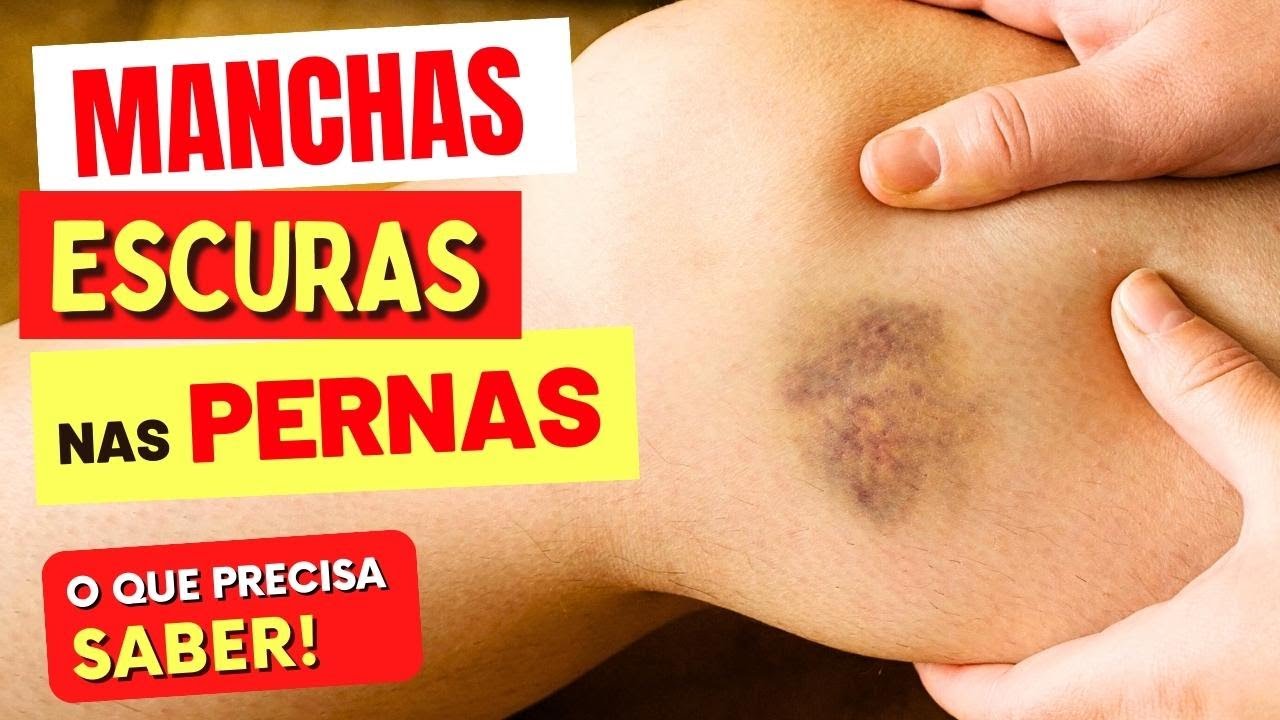 MANCHAS ESCURAS NAS PERNAS - O que você PRECISA SABER! - YouTube