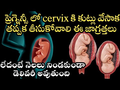 cervical cerclage care during pregnancy - YouTube