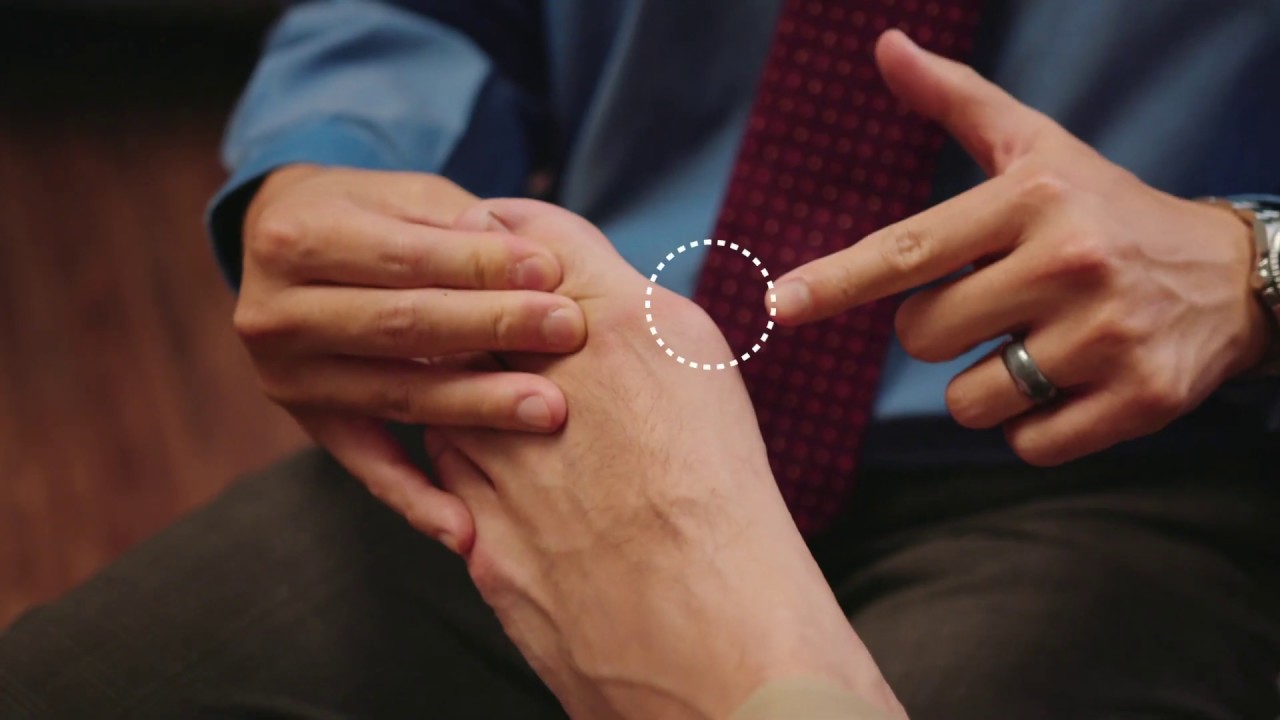How to Treat Bunions and Other Foot Deformities - YouTube