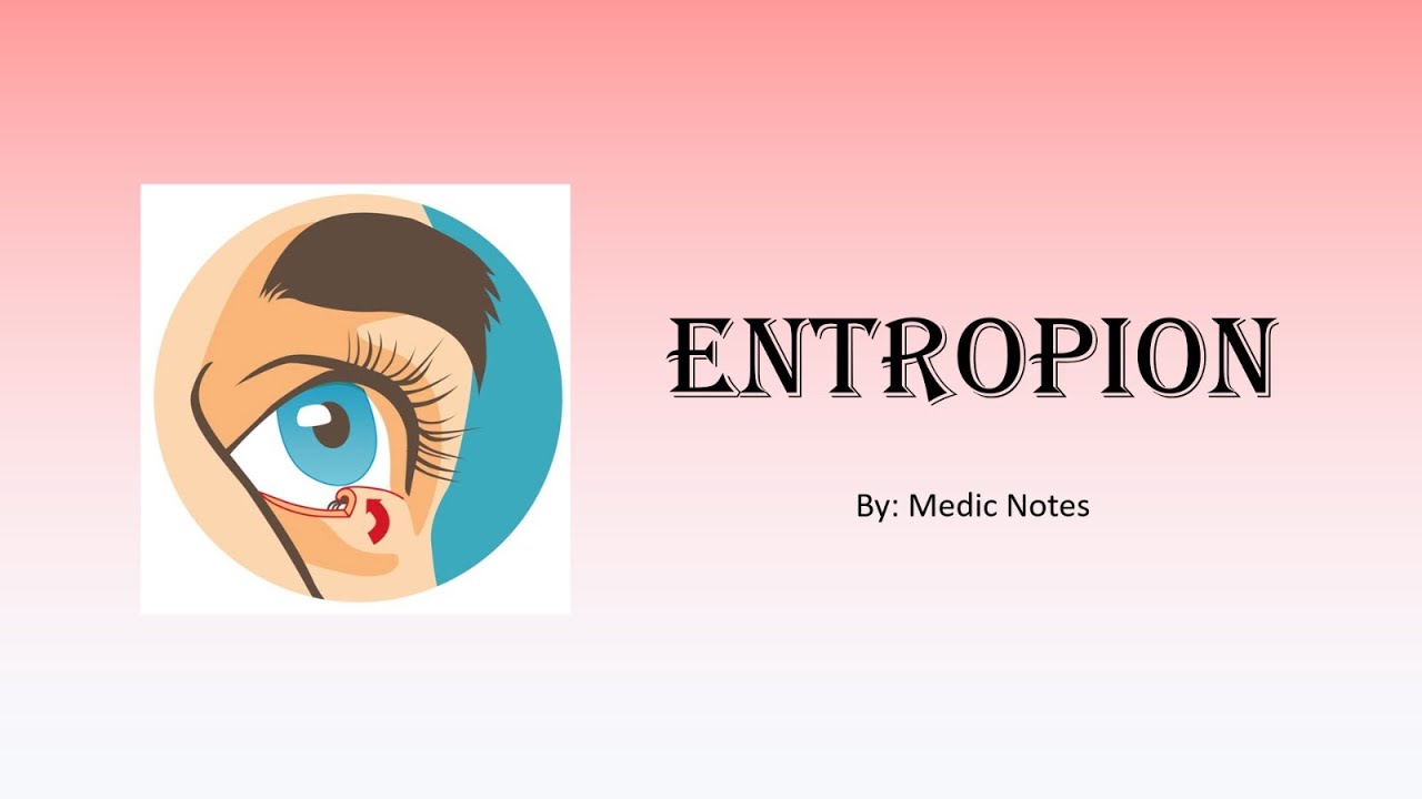 Entropion causes, complications, treatment and management - YouTube