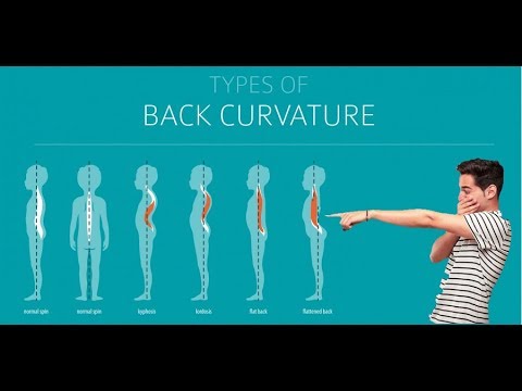 Flatback Syndrome Assessment - YouTube