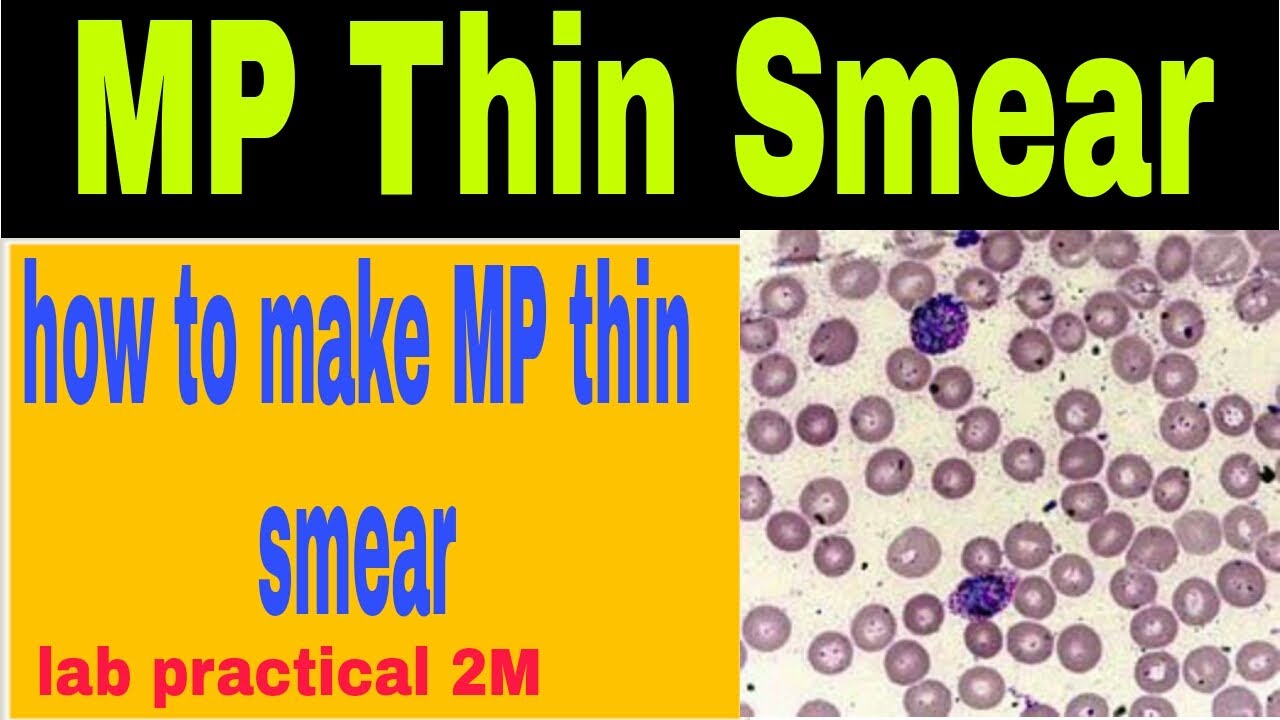 Malaria thin smear preparation,how to make thin blood smear - YouTube