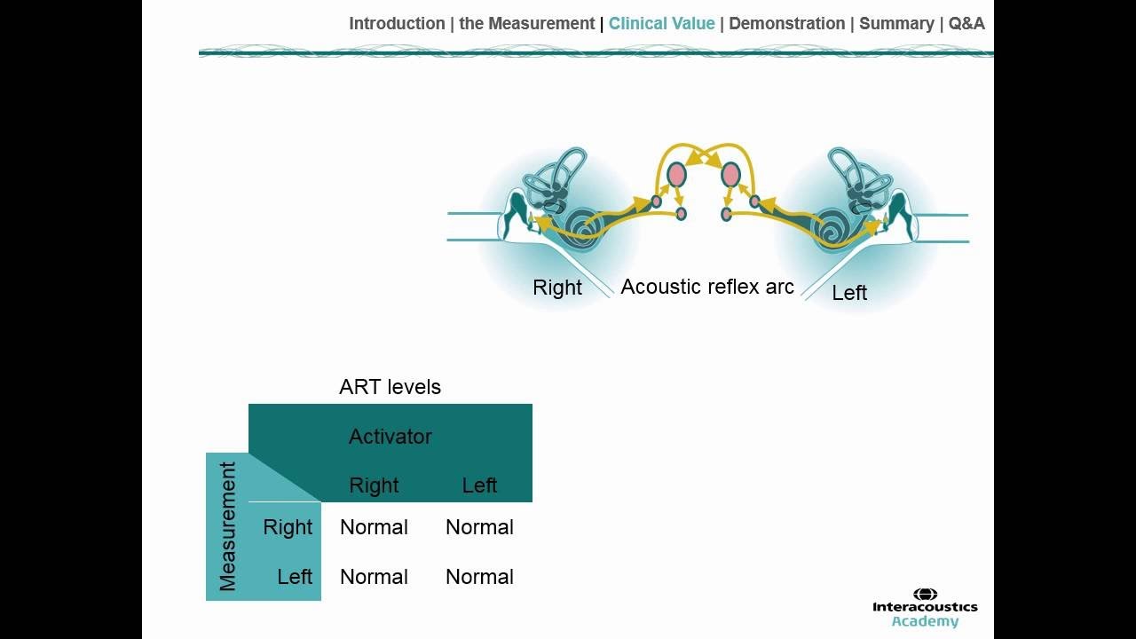 Acoustic Reflex ( ART )/ Stapedius Reflex ( SRT ) | Bangla | Mohammad ...