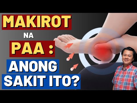 Makirot na Paa : Anong Sakit Ito? - Tips by Doc Willie Ong (Internist ...