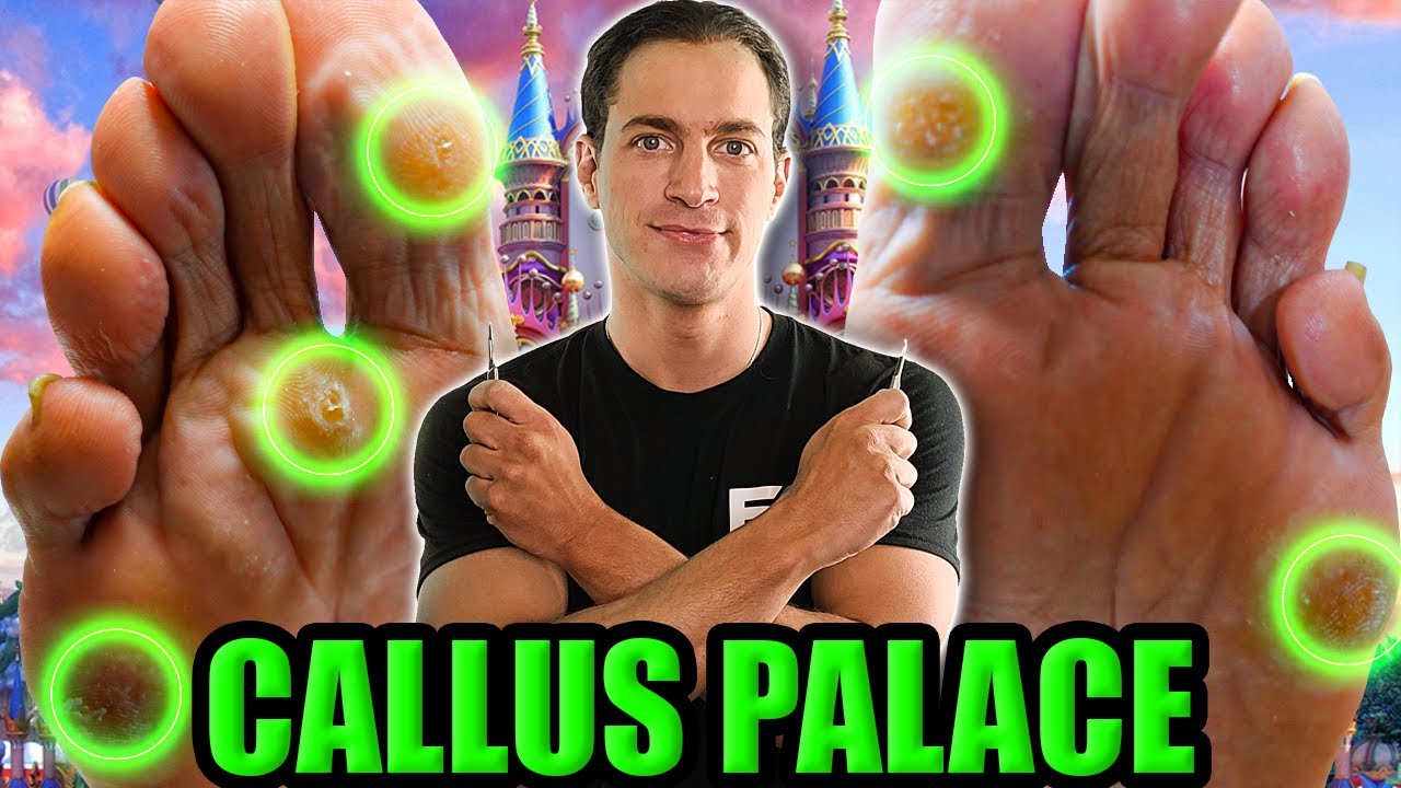 Callus Palace: Cutting Out Multiple Painful Calluses! - YouTube