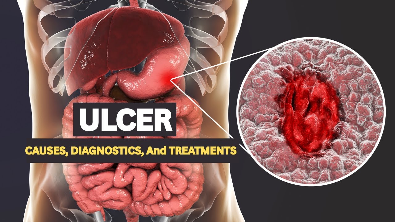 Ulcer, Causes, Signs and Symptoms, Diagnosis and Treatment. - YouTube
