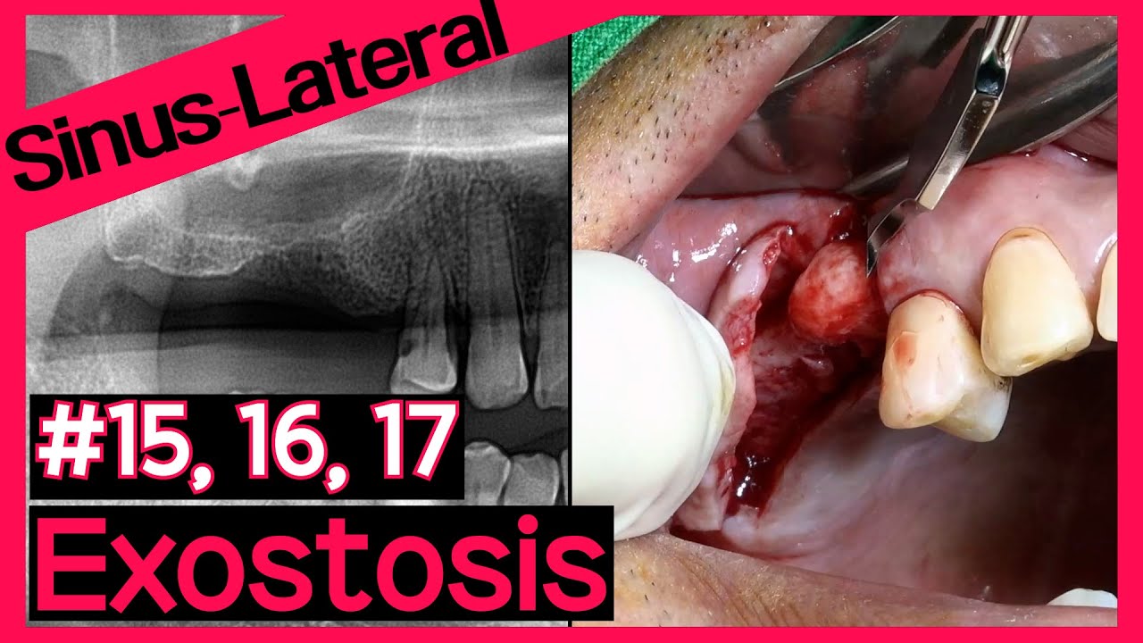 [Online Surgery] Sinus graft using LAS KIT & Excision of bony exostosis ...