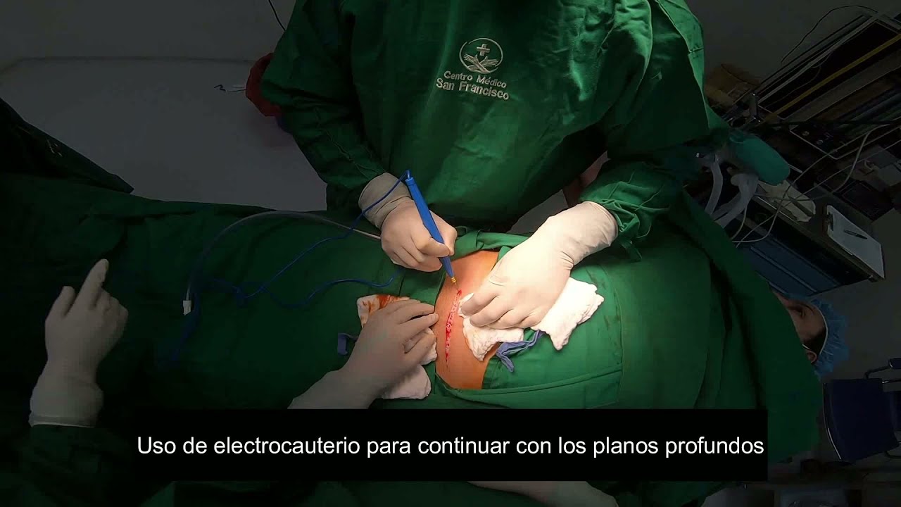 Passo A Passo Parto Cesárea - FDPLEARN