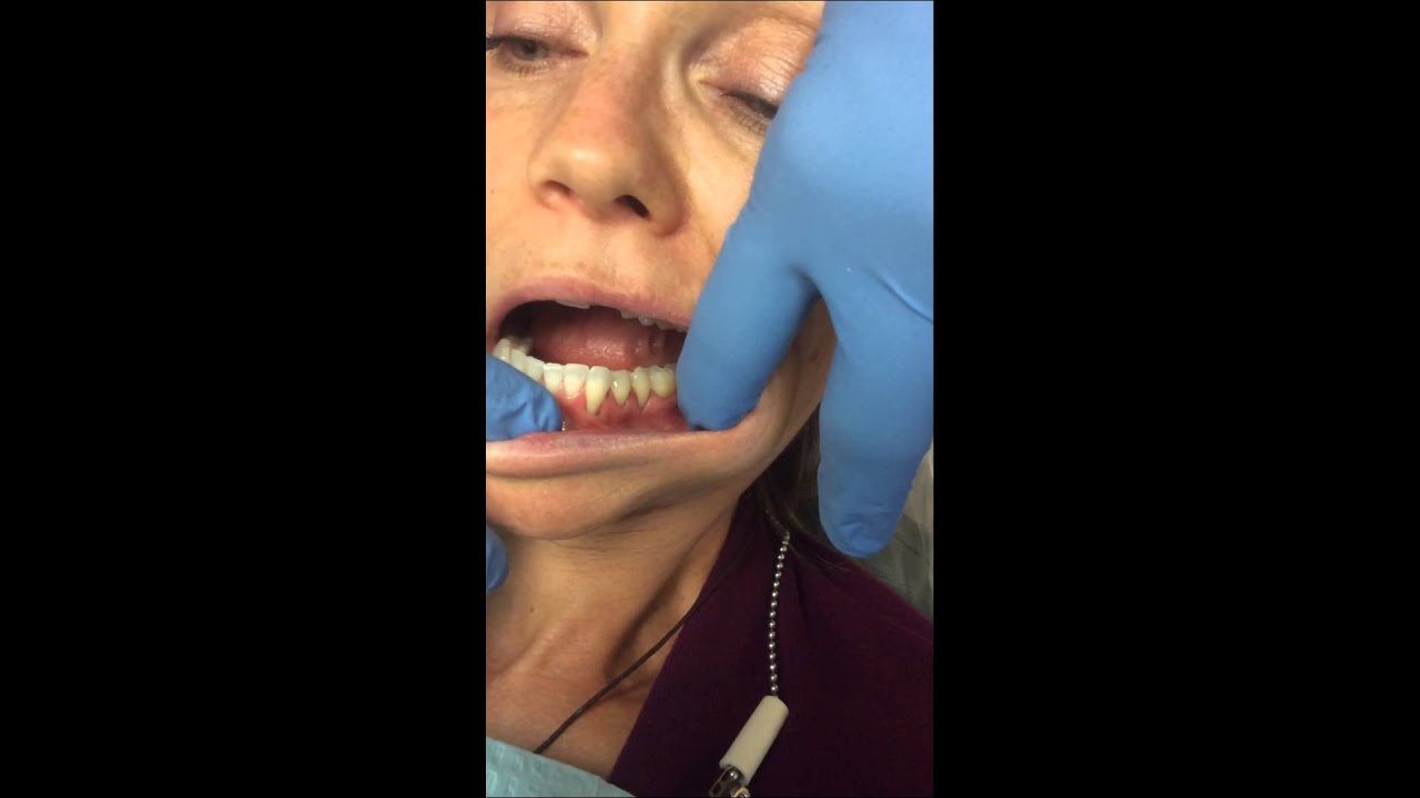 Dental Abfractions Part II - YouTube