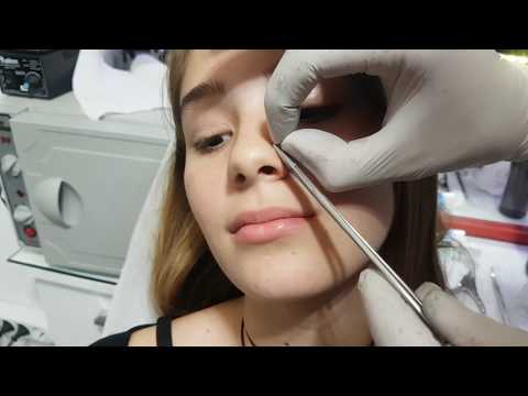 Burun Piercing Sonrası Halkaya Geçiş ?