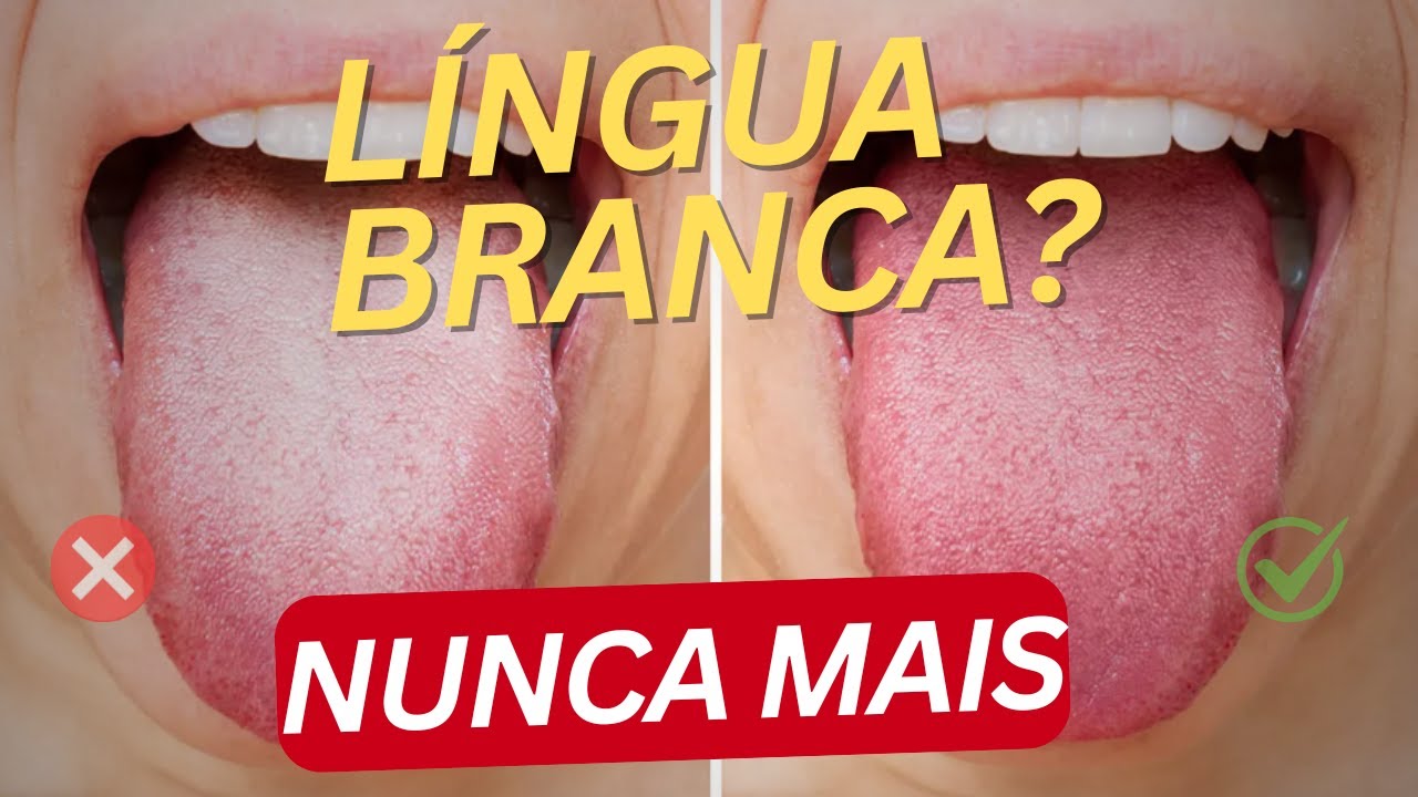 Língua Branca? Mau hálito? Descubra tudo sobre a Saburra Lingual! - YouTube