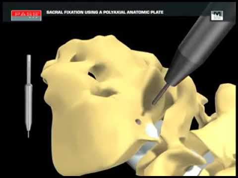 SISTEMA PASS LP (MEDICREA) - YouTube