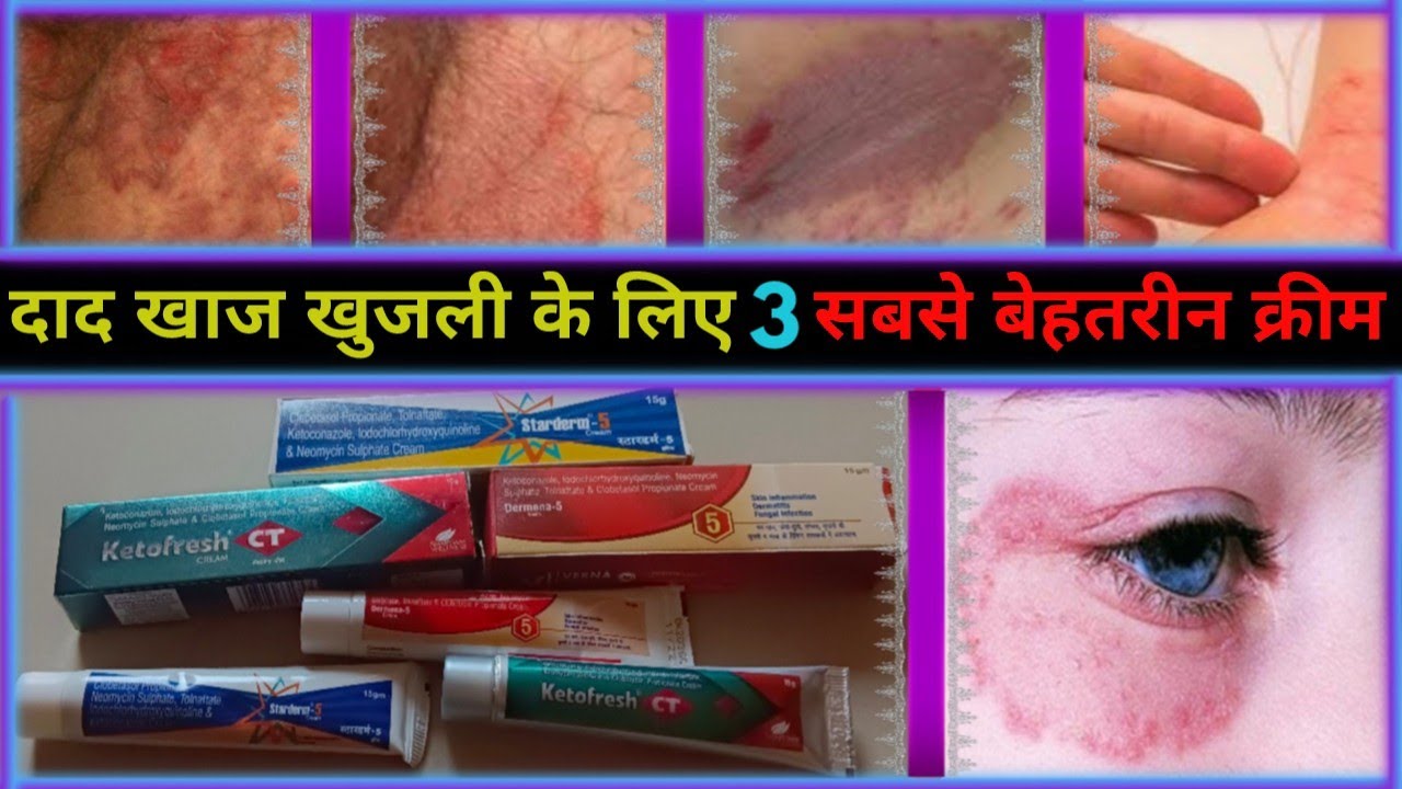 (दाद खाज खुजली जड़ से खत्म कर देगा यह क्रीम) Ketofresh ct cream uses in ...