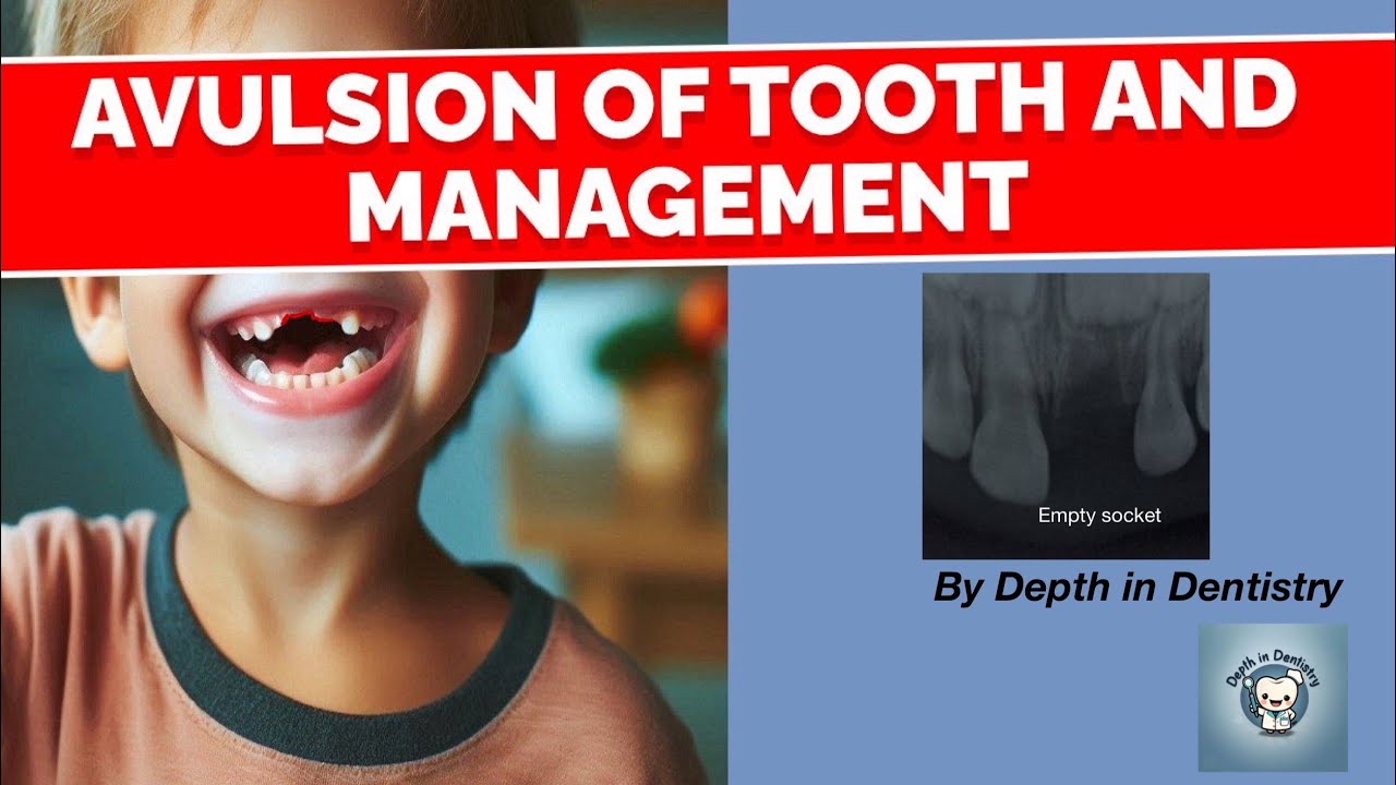 AVULSION - DENTAL TRAUMA (PART 1) - YouTube