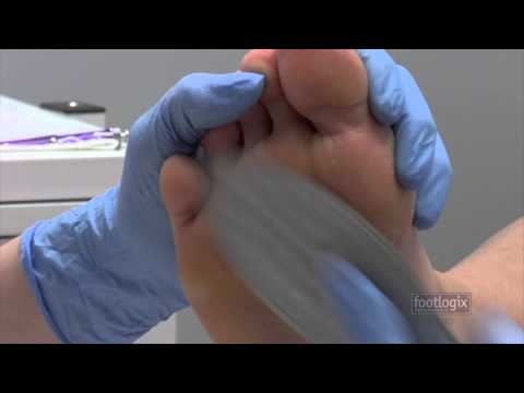 How to Remove Callus | Foot Callus Remover