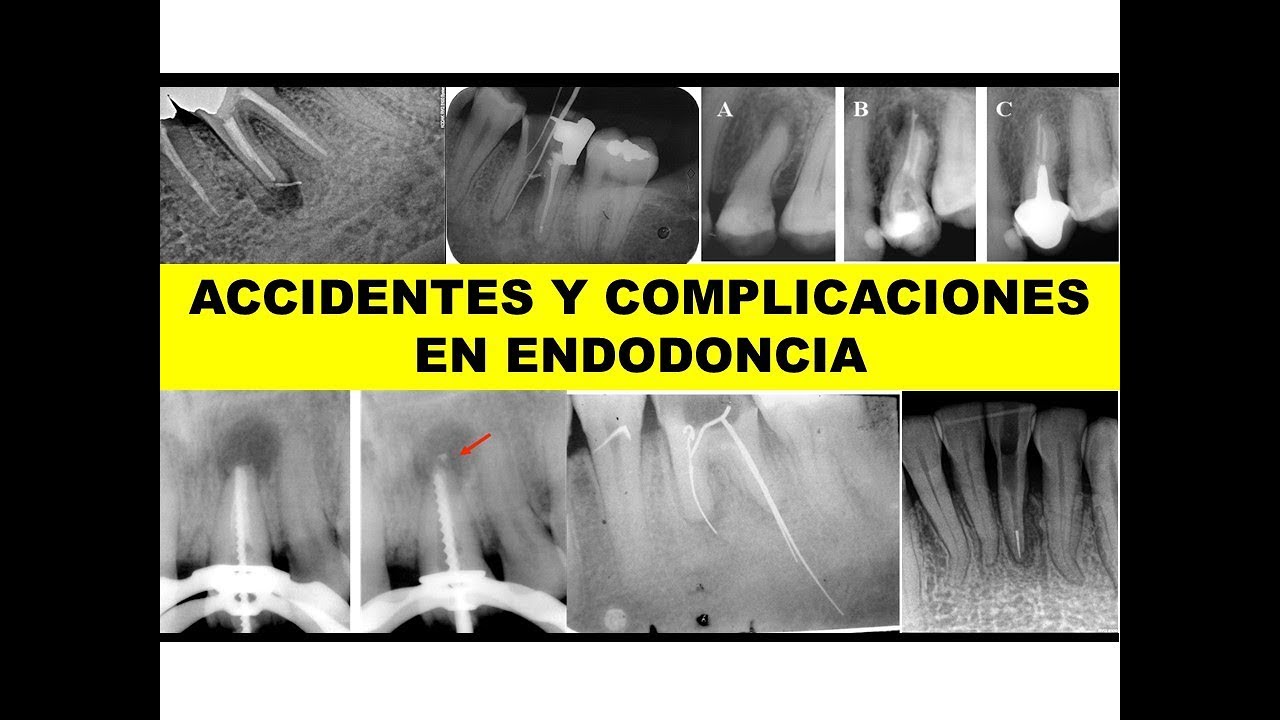 "ACCIDENTES Y COMPLICACIONES EN ENDODONCIA" por el Dr. Bruno Lujan ...