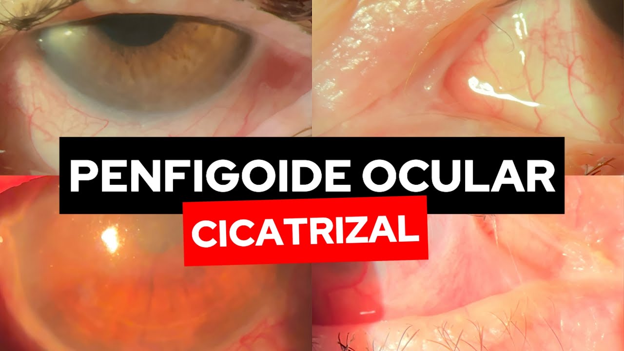 ¿Que es el penfigoide ocular cicatrizal? Conoce sus efectos en la ...