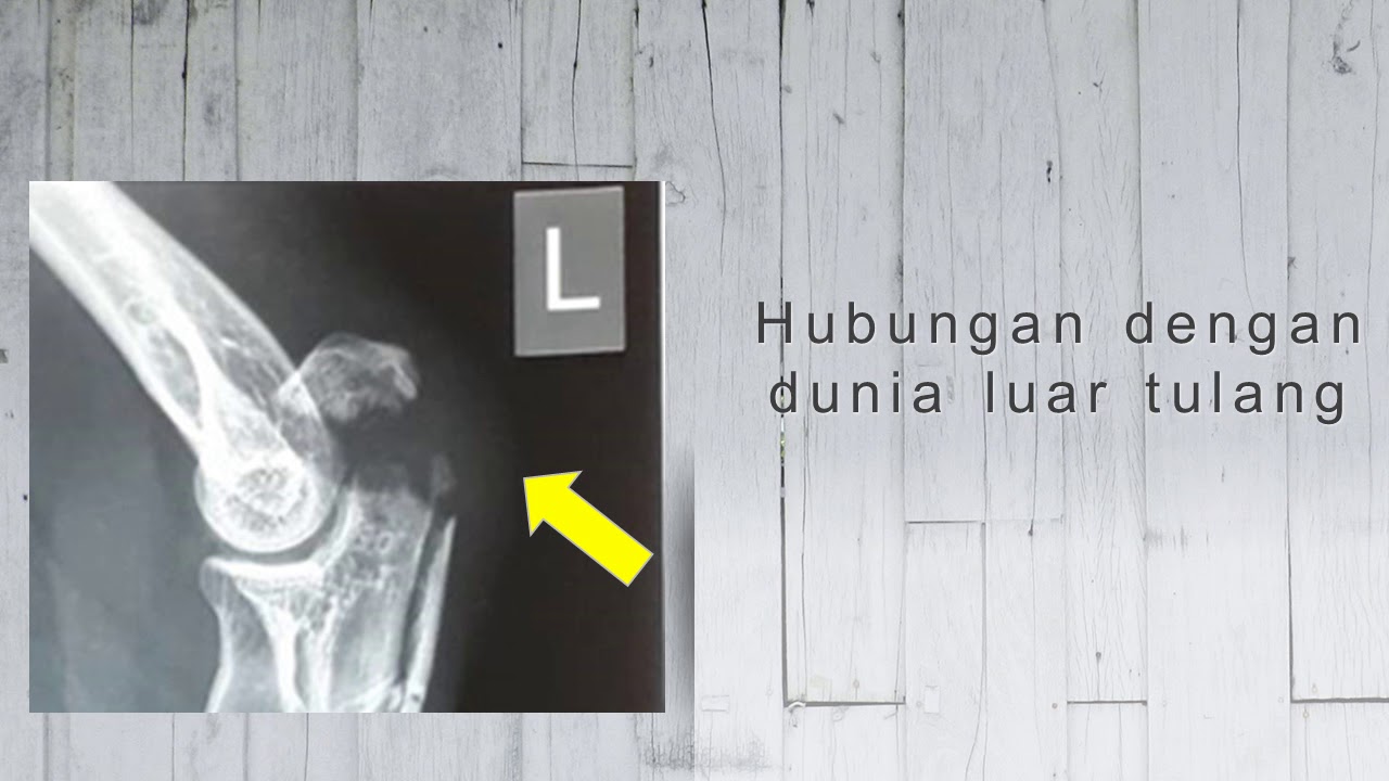 Interpretasi Hasil Pemeriksaan Rontgen Fraktur Olecranon Ulnae -- ALIZA ...