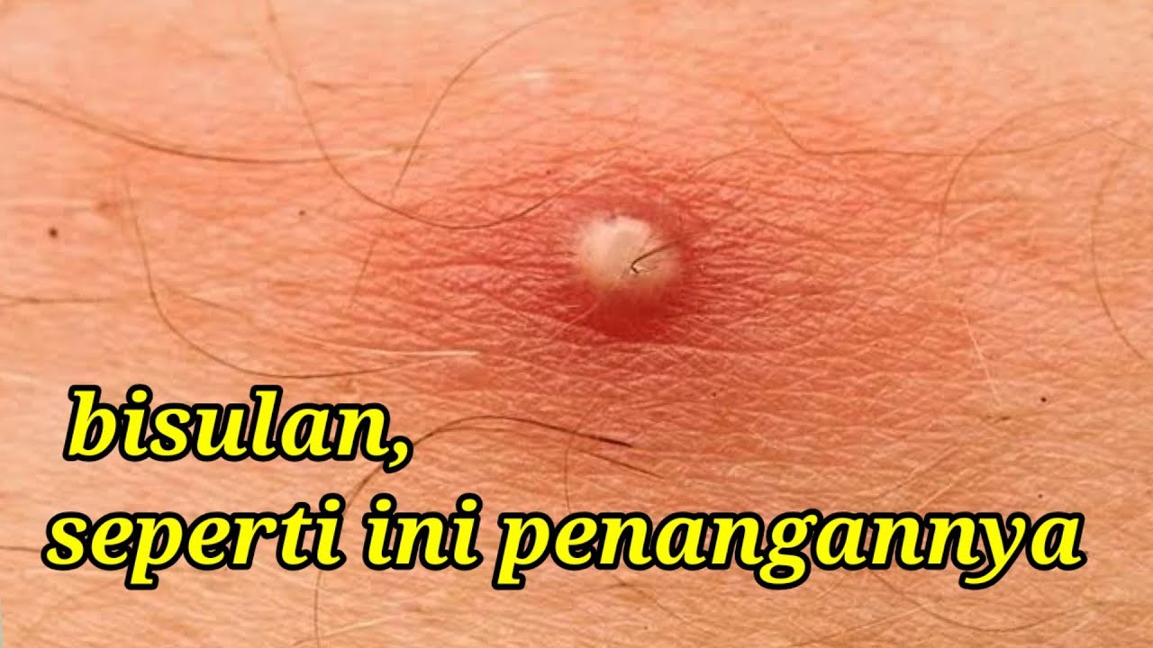 Bisul#penyakit#penyakitkulit - YouTube