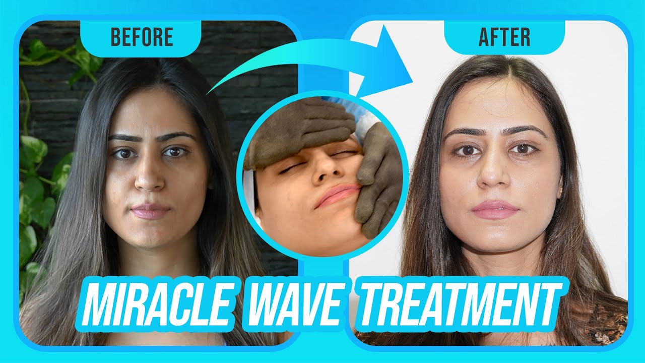 Procedure of Miracle Wave Treatment | Results | Instant Glow | Sakhiya ...