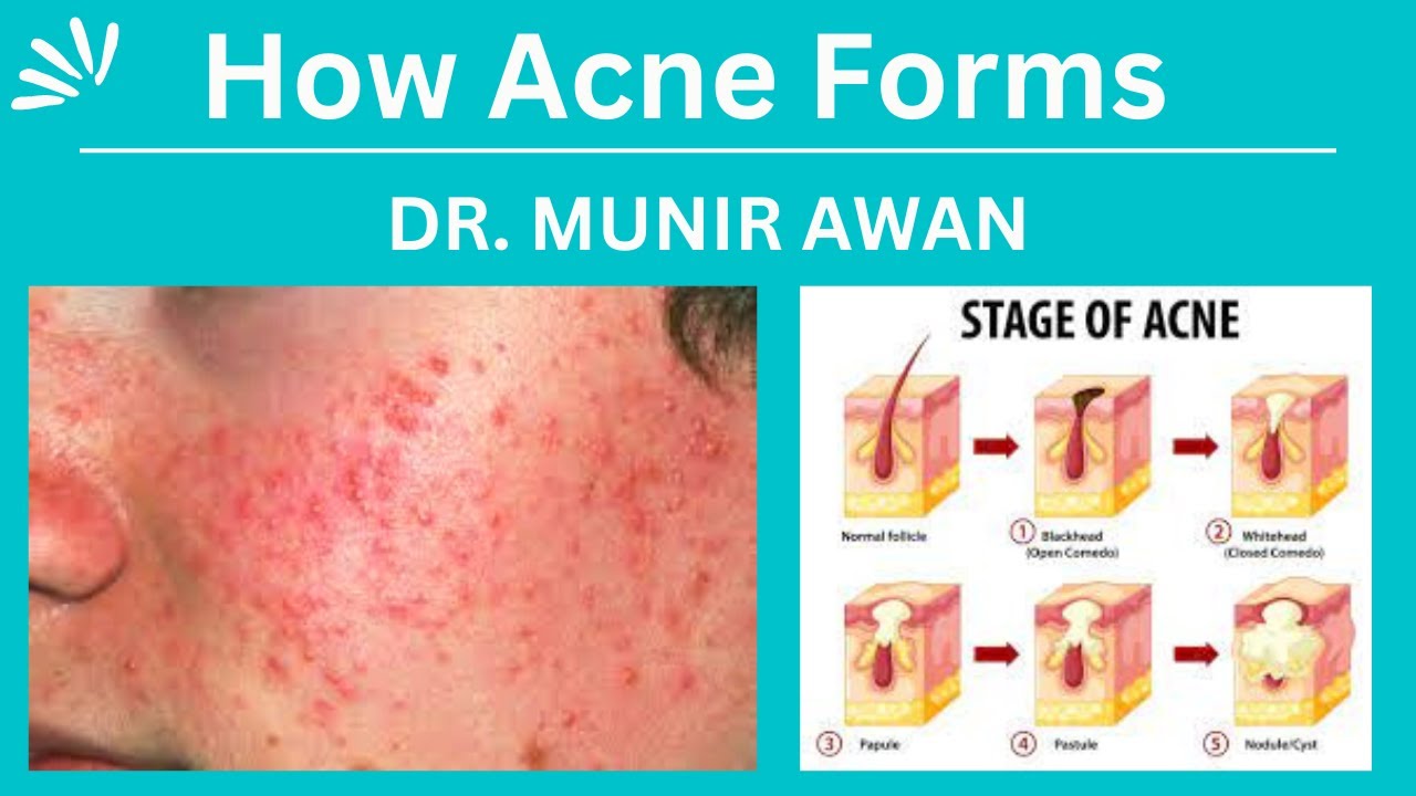 ACNE , - YouTube