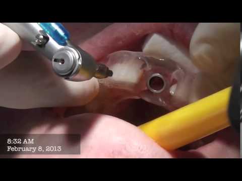 Dr Scott Pope DDS - Galileos, CEREC, Fully Guided Implant Placement ...