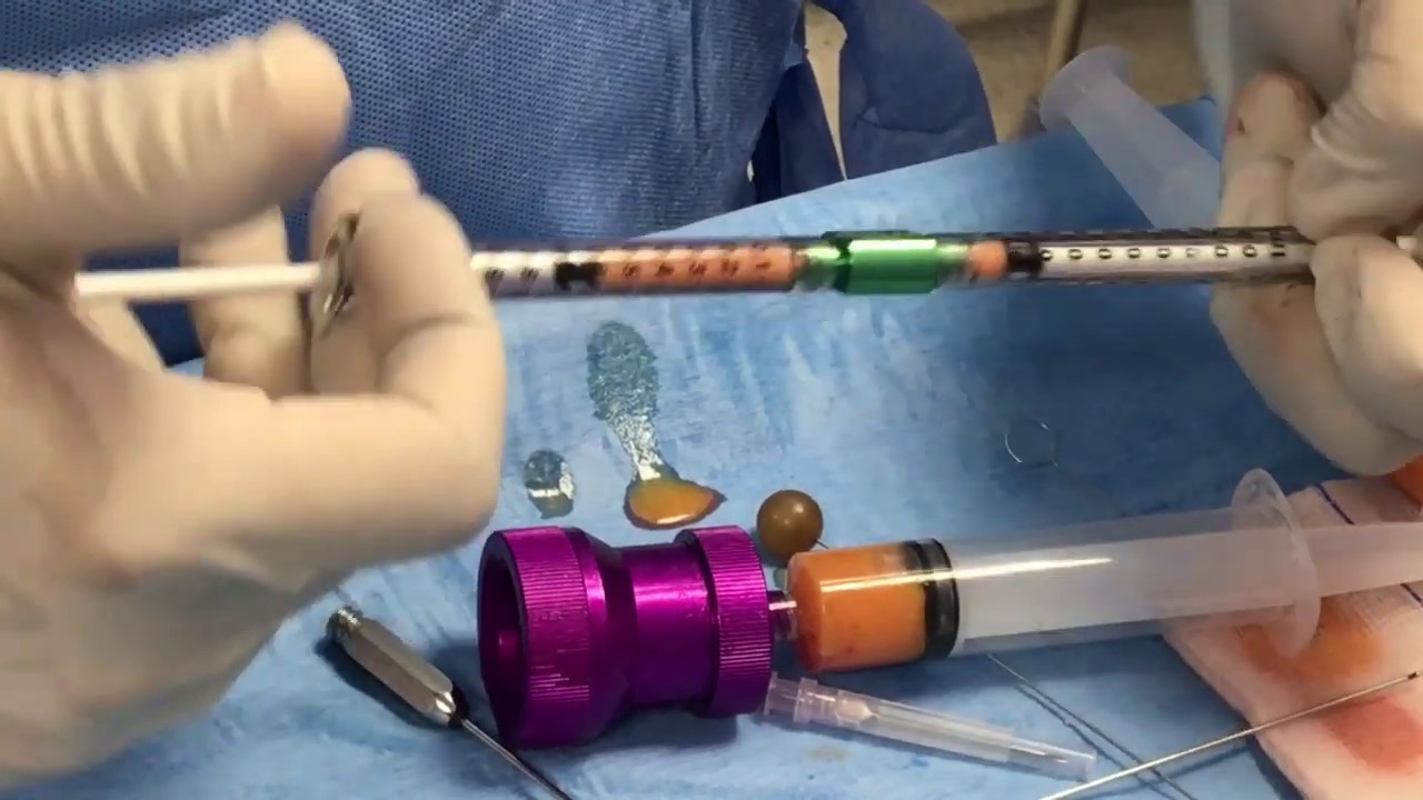 Technique Of Fat Grafting Face How To Prepare Macro Micro And Nanofat Grafts YouTube Technique Of Fat Grafting Face How To Prepare Macro Micro And Nanofat Grafts YouTube
