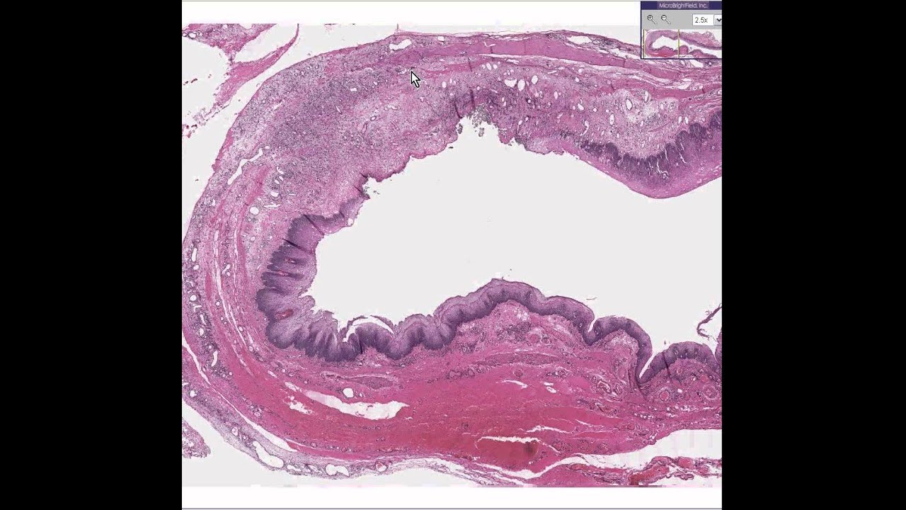 Esophagus Zenkers diverticulum - YouTube