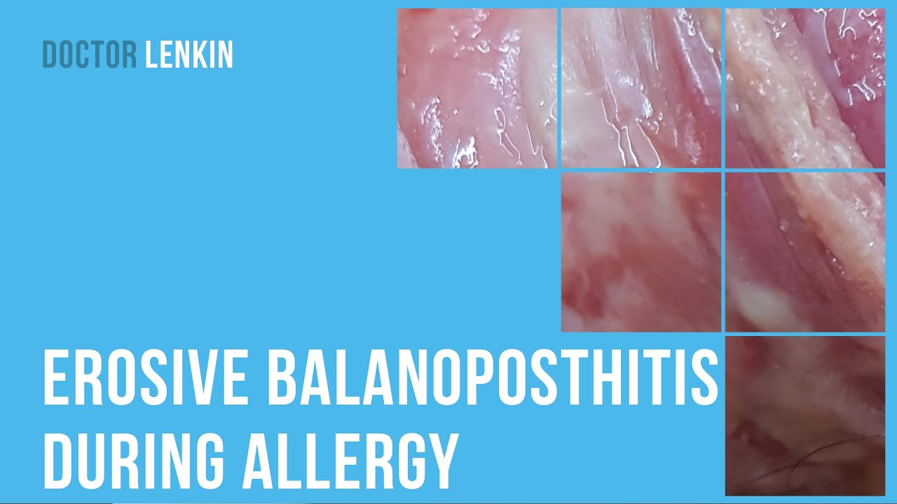 💣 Erosive balanoposthitis during allergy - YouTube
