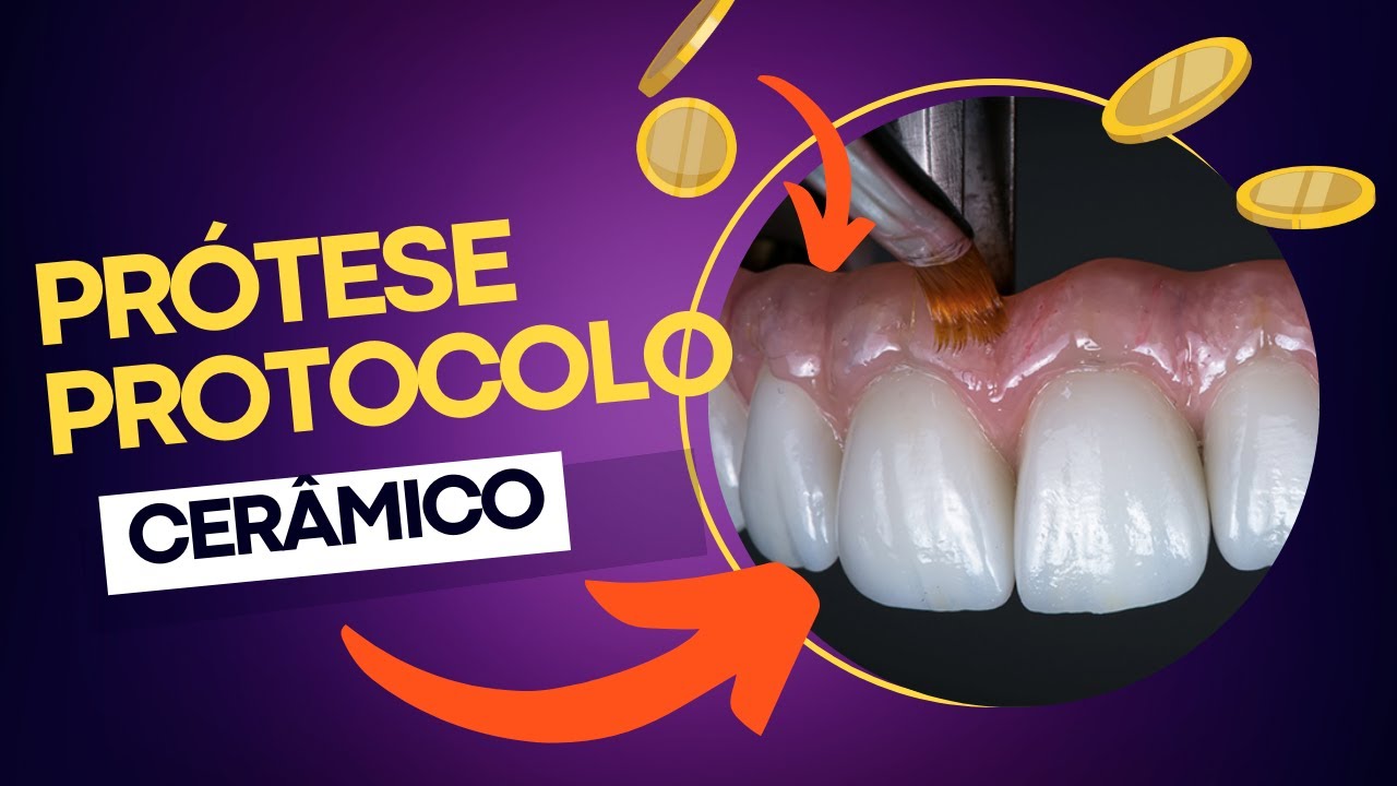 Prótese protocolo cerâmico @dr.alexguedes - YouTube