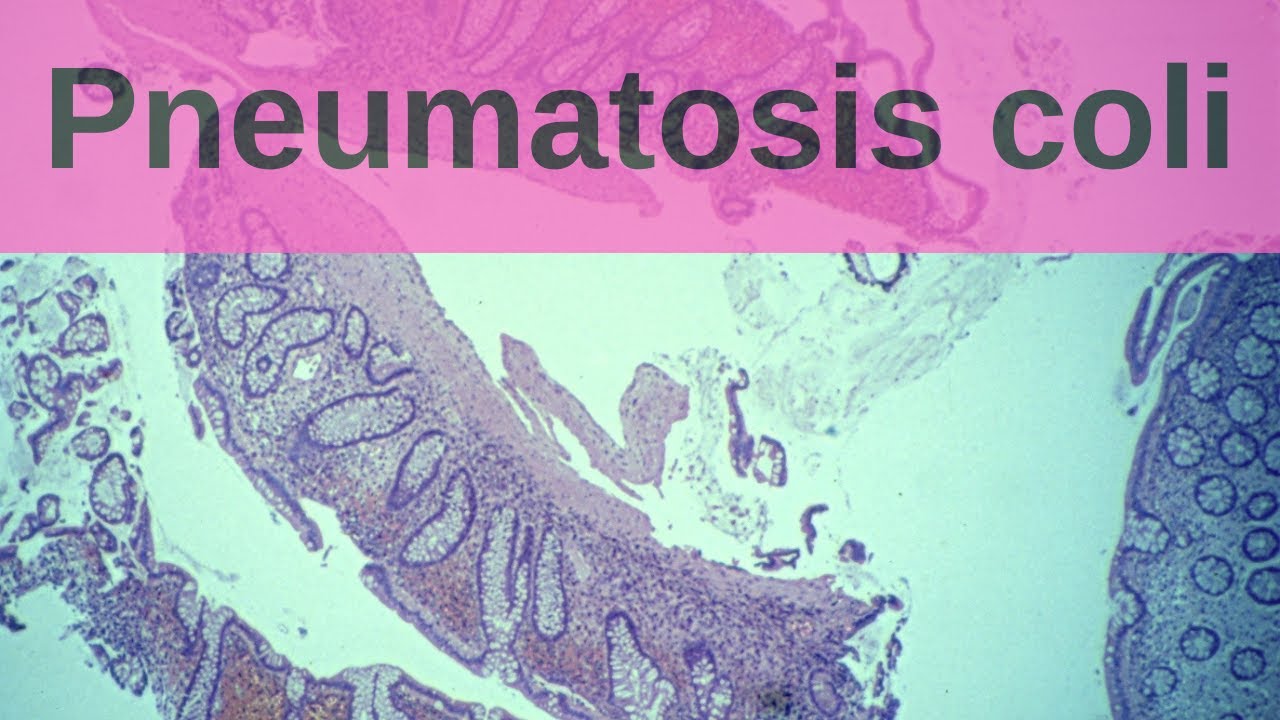 Pneumatosis Coli - Pathology mini tutorial - YouTube